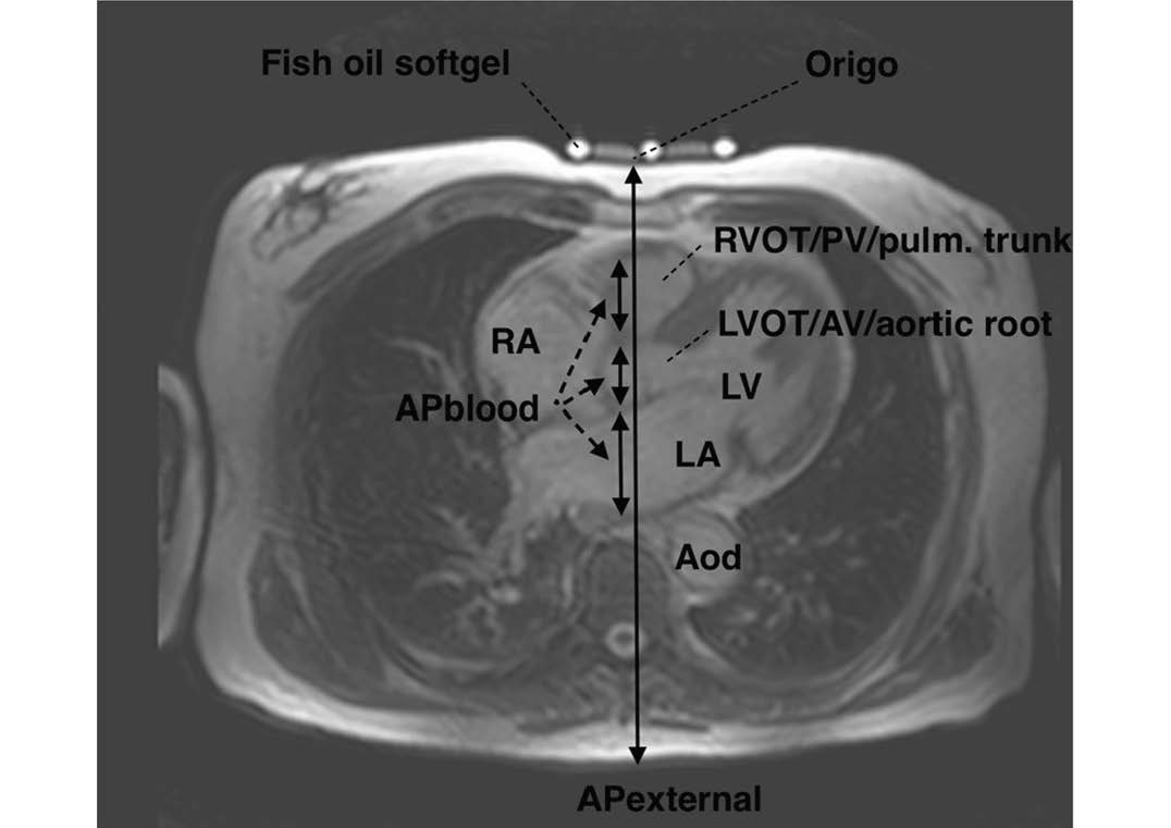 Chest compression point. Are we compressing in the right place ...